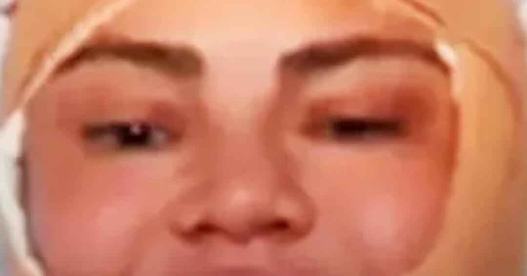 Chrissy Teigen zeigt sich nach Beauty-OP mit bandagiertem Kopf - Video ...